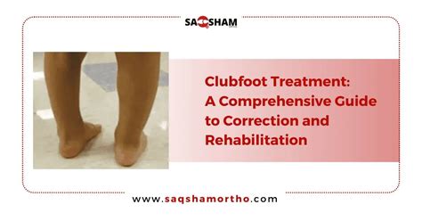 Clubfoot Treatment A Comprehensive Guide To Correction And Rehabilitation