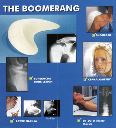 Octostop® The Boomerang® X Ray Compensating Filter