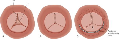 Atrioventricular Canal Defects Clinical Tree