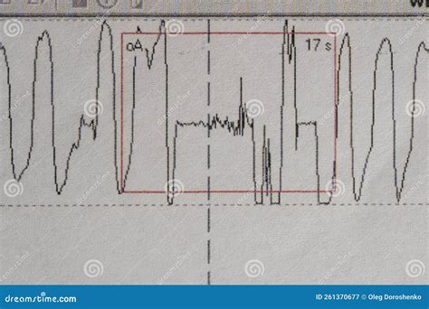 Images Charts Scientific Cardiograms Of Cardiorespiratory Sleep