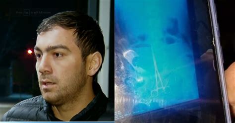 ვიდეო სოსს ოპერაციისას 22 წლის გოგონას მუცლის ღრუში მაკრატელი ჩაუტოვეს ნახეთ რა მოხდა და