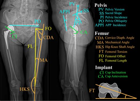Pelvis And Femur Geometry Parameters Diaph Diaphyseal Download Scientific Diagram