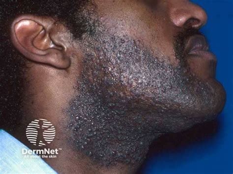 Pseudofolliculitis Barbae Image