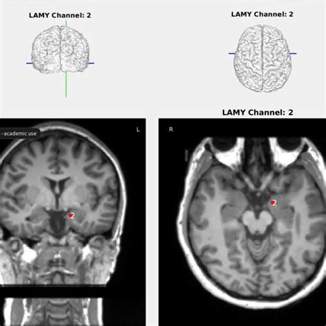 Modular Reconstruction And Co Registration Of Imaging From Implanted