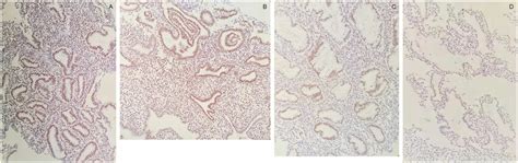 The Expression Of Estrogen Receptor In The Endometrium Download
