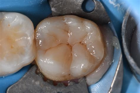Resin Composite Esthetics Molar Resin Composite Esthetics Molar