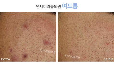 여드름and모공and흉터 연세미라클의원