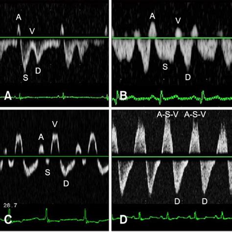 Three Types Of Hepatic Venous Flow Patterns In Dogs With Tricuspid