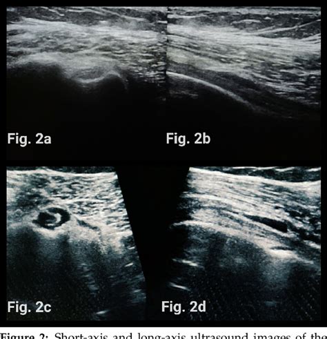 Figure 1 From Abnormal Findings In The Shoulder Of Asymptomatic Adults