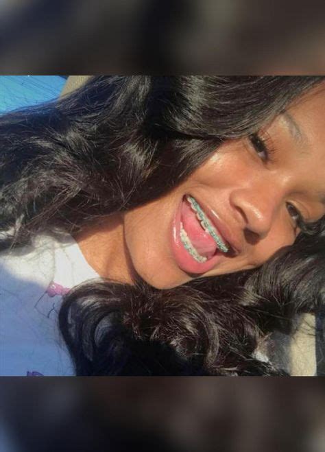 Selena Gomez Braces