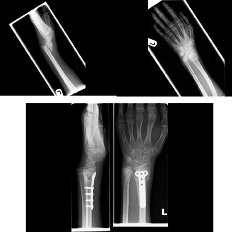 Intraoperative Fluoroscopy Left Wrist Post Repair Download