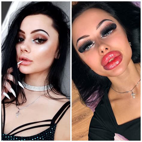 My Lips Transformation Do You Think They Should Be Bigger R Fillerdolls