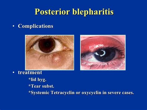 Eyelid