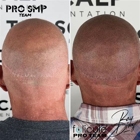 Scalp Micropigmentation In North Carolina Virginia Top Scalp Micro Scalp Micropigmentation In North Carolina Virginia Top Scalp Micro