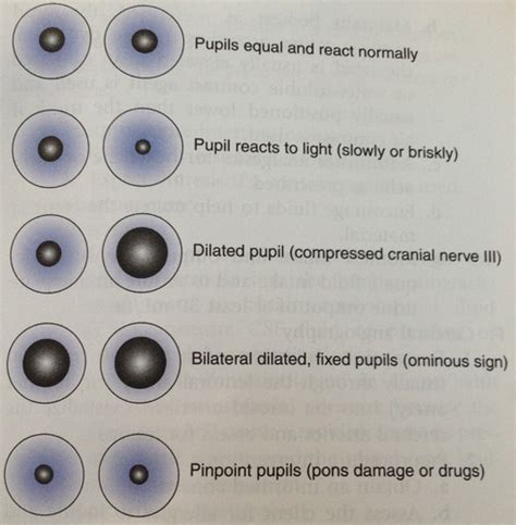 Increased Intracranial Pressure Icp Flashcards Quizlet