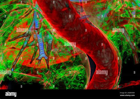 Aorta And Lung Airways 3d Computed Tomography Ct Scan Of Parts Of The Aorta Red With Lung