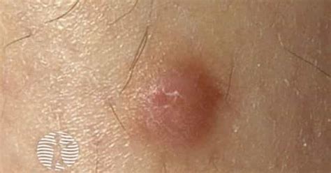 Dermatofibrosarcoma Protuberans Image