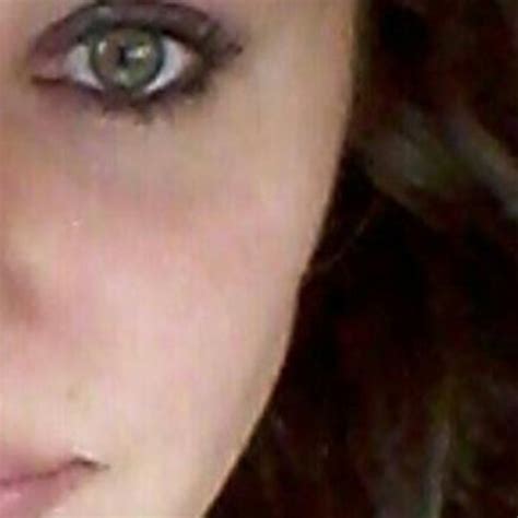 Nose Webbing Birth Defect