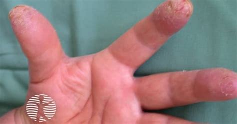Dermnet® Contact Allergic Dermatitis Of The Hands Image