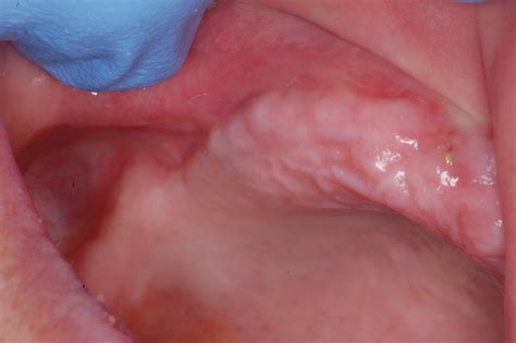 Periodontal Implant Cases By Dr Thomas Kang A Maxillary Overdenture