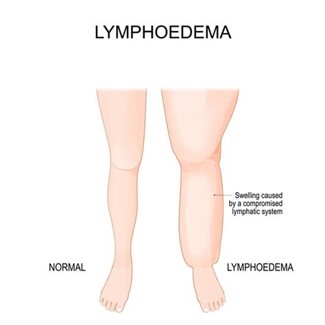 3 Complete Decongestive Therapy Stock Vectors And Vector Art Shutterstock