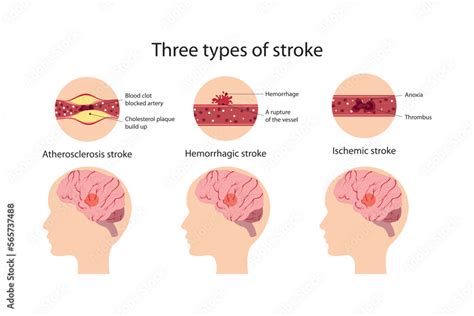 Three Types Of Stroke Atherosclerosis Hemorrhagic And Ischemic Stroke