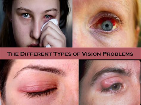 The Different Types Of Vision Problems Pdf