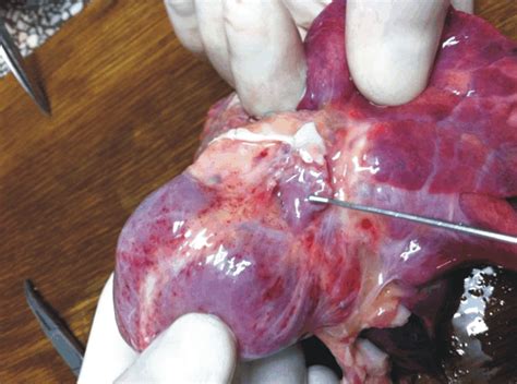 Hypoplastic Left Atrium Figure 2 Pulmonary Veins Obstruction And Download Scientific Diagram