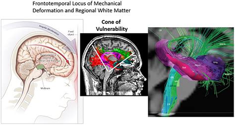 Left From Ropper And Gorson 2007 Depicting The Movement Of Brain Download Scientific