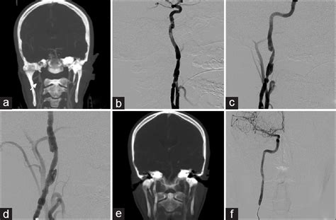 Surgical Neurology International