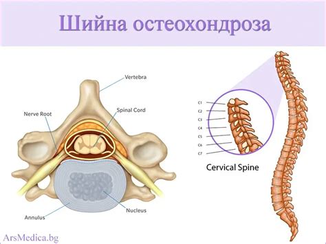 Шийна остеохондроза цервикална остеохондроза Arsmedica Bg