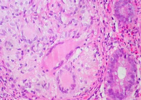 Quick Take Trends In Diverting Loop Ileostomy Vs Total Abdominal Colectomy As Surgical
