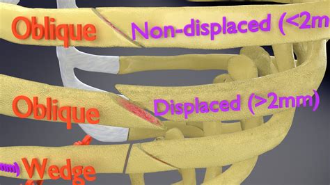 Rib Fracture And Its Types Superhive Formerly Blender Market