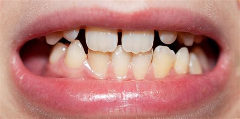 Malocclusion Of Teeth Classification Causes Treatment And More