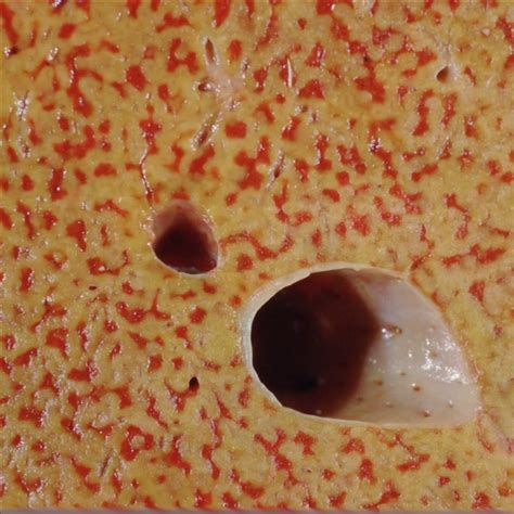 Congestive Hepatopathy Pacs