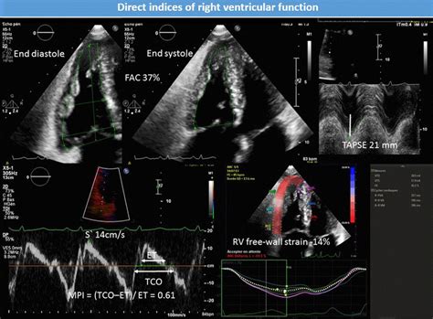 Ef Trong Siêu âm Tim Chỉ Số Quan Trọng Trong đánh Giá Sức Khỏe Tim Mạch