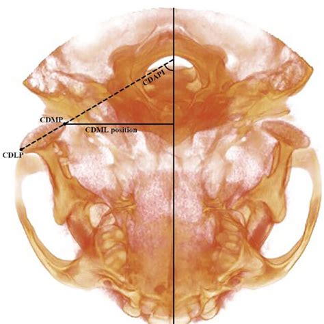 Condylar Position And Inclination To The Midsagittal Plane In Rma Download Scientific Diagram