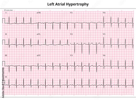 Ecg Left Atrial Hypertrophy Lah Left Atrial Enlargement Lae 12