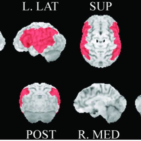 Cortical Surface Map Of The Mca Territory Superimposed On Neurostat T