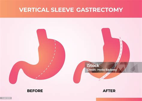 복강경 소매 위 절제술 수직 위 절제술 체중 감량 수술 위 축소 수술의 벡터 그림 소매 의복에 대한 스톡 벡터 아트 및 기타 이미지 소매 의복 내시경 수술 Istock
