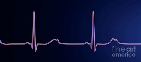 Long Qt Syndrome Type 2 Electrocardiogram 11 Photograph By Kateryna Kon Science Photo Library