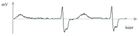 Electrocardiogram Signal Download Scientific Diagram