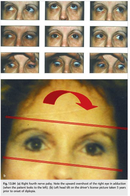 Questions Of The Week Noi13 Diplopia 6 4th Nerve Palsy — Neuro