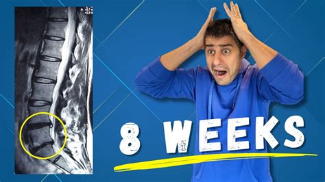 L4 L5 L5 S1 Disc Herniation Recovered Pain Free Without Surgery Youtube