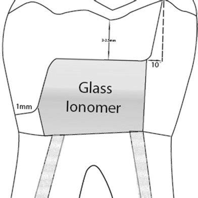 Ceramic Inlay Preparation Design For Posterior Endodontically Treated