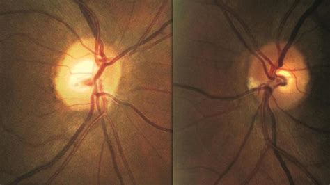 Oct Casebook Disc Analysis