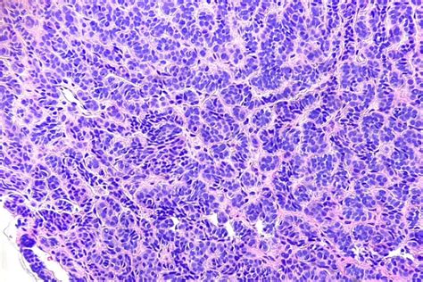 Sebaceous Hyperplasia Sebaceous Adenoma Sebaceoma And Sebaceous Epithelioma Mckee Derm