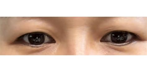 리얼후기 1 페이지 눈이 예쁘다그래서 아몬드성형외과