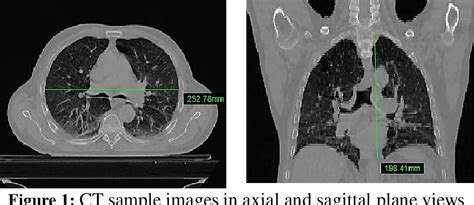 Figure 1 From 3d Lung Segmentation On Ct Images Using Region Based