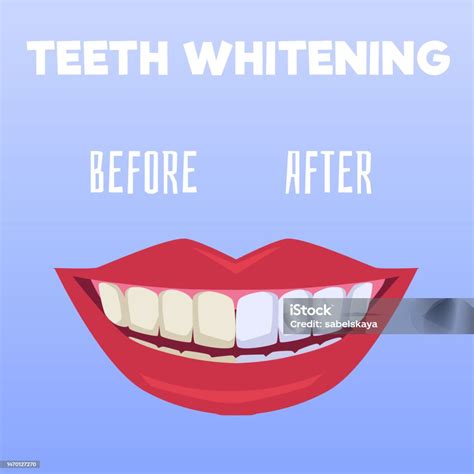 치아 미백 플랫 스타일 벡터 일러스트 레이 션에 대 한 사각형 배너 건강관리와 의술에 대한 스톡 벡터 아트 및 기타 이미지 건강관리와 의술 기대 깨끗한 Istock